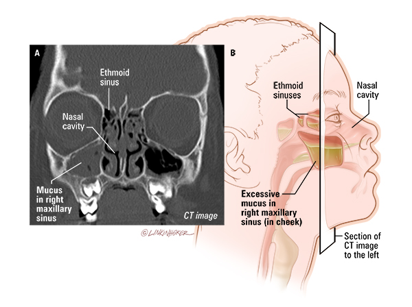 Effects of CF - Johns Hopkins Cystic Fibrosis Center